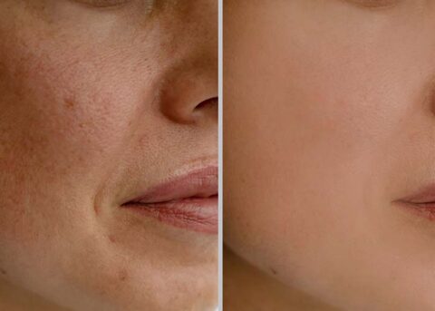 Skin Pigmentation : Causes, Types & Treatments | Dr. Priti Shukla