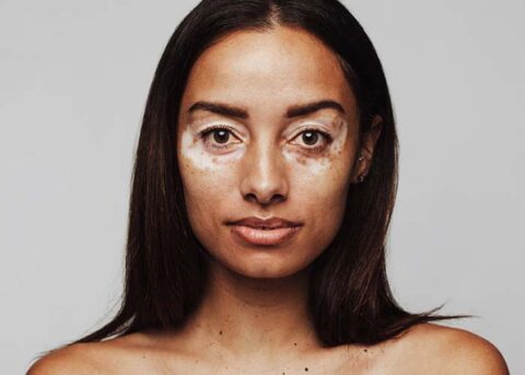 Skin Pigmentation : Causes, Types & Treatments | Dr. Priti Shukla